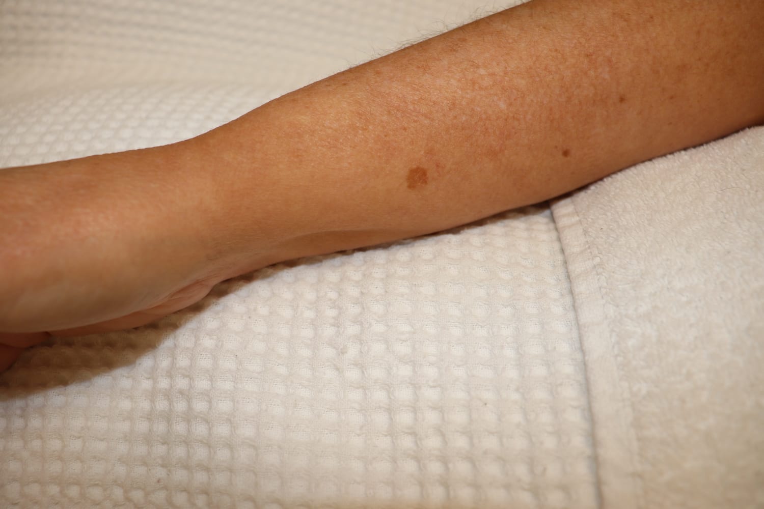 Pigment | Huidkliniek Voorne-Putten